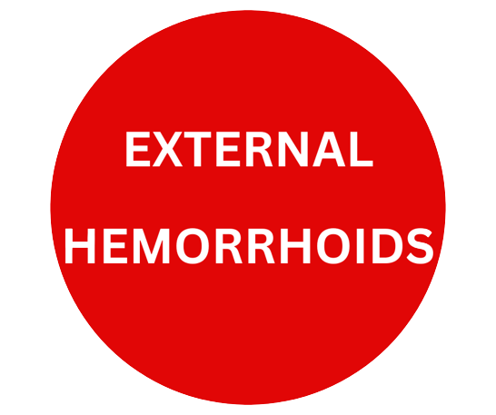 Hemorrhoids - BNH HOSPITAL