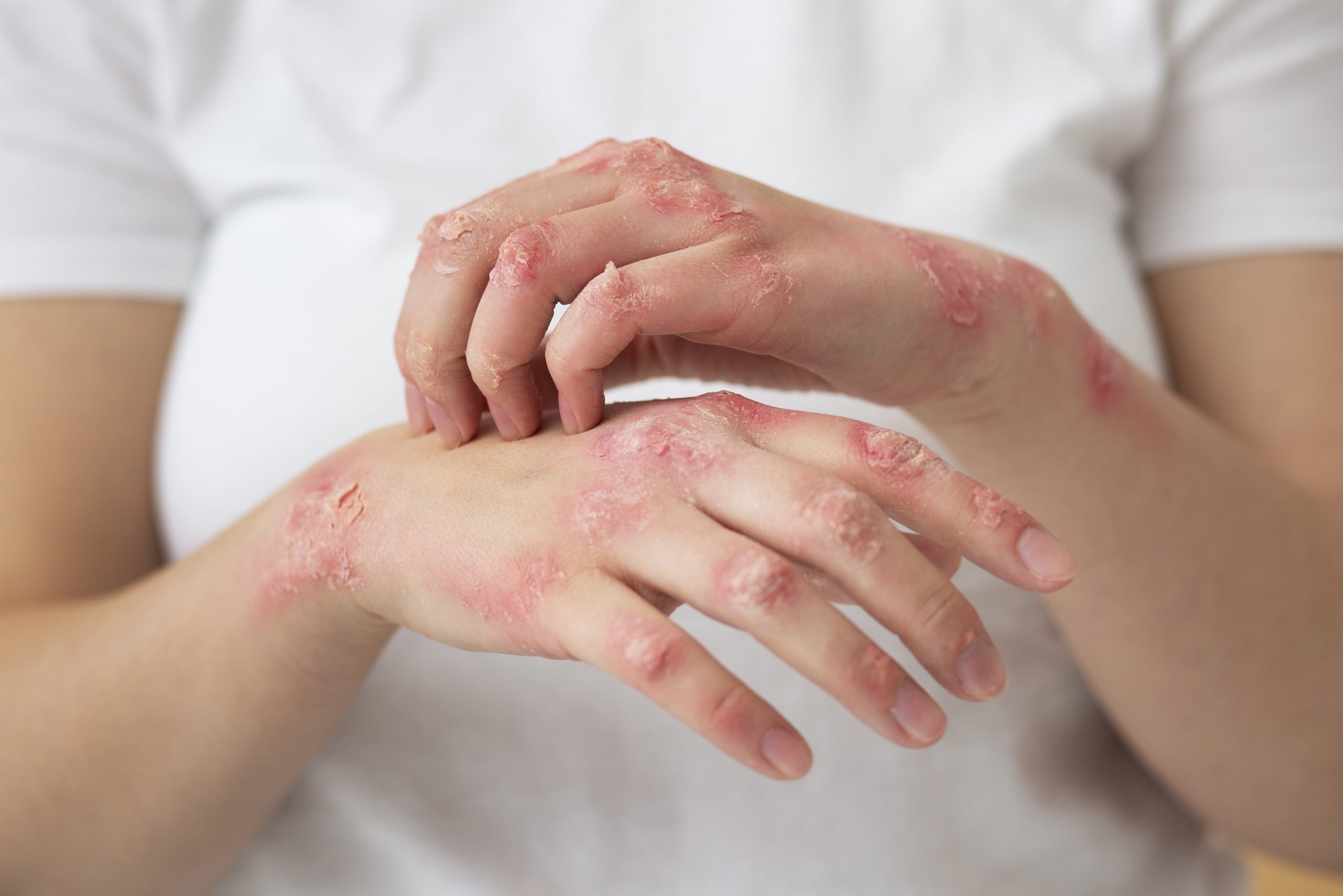 โรคงูสวัด (Herpes Zoster/Shingles) คืออะไร? - BNH HOSPITAL
