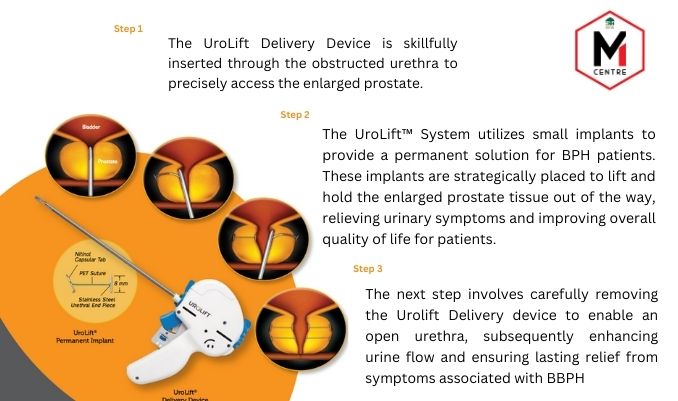 Urolift - BNH HOSPITAL
