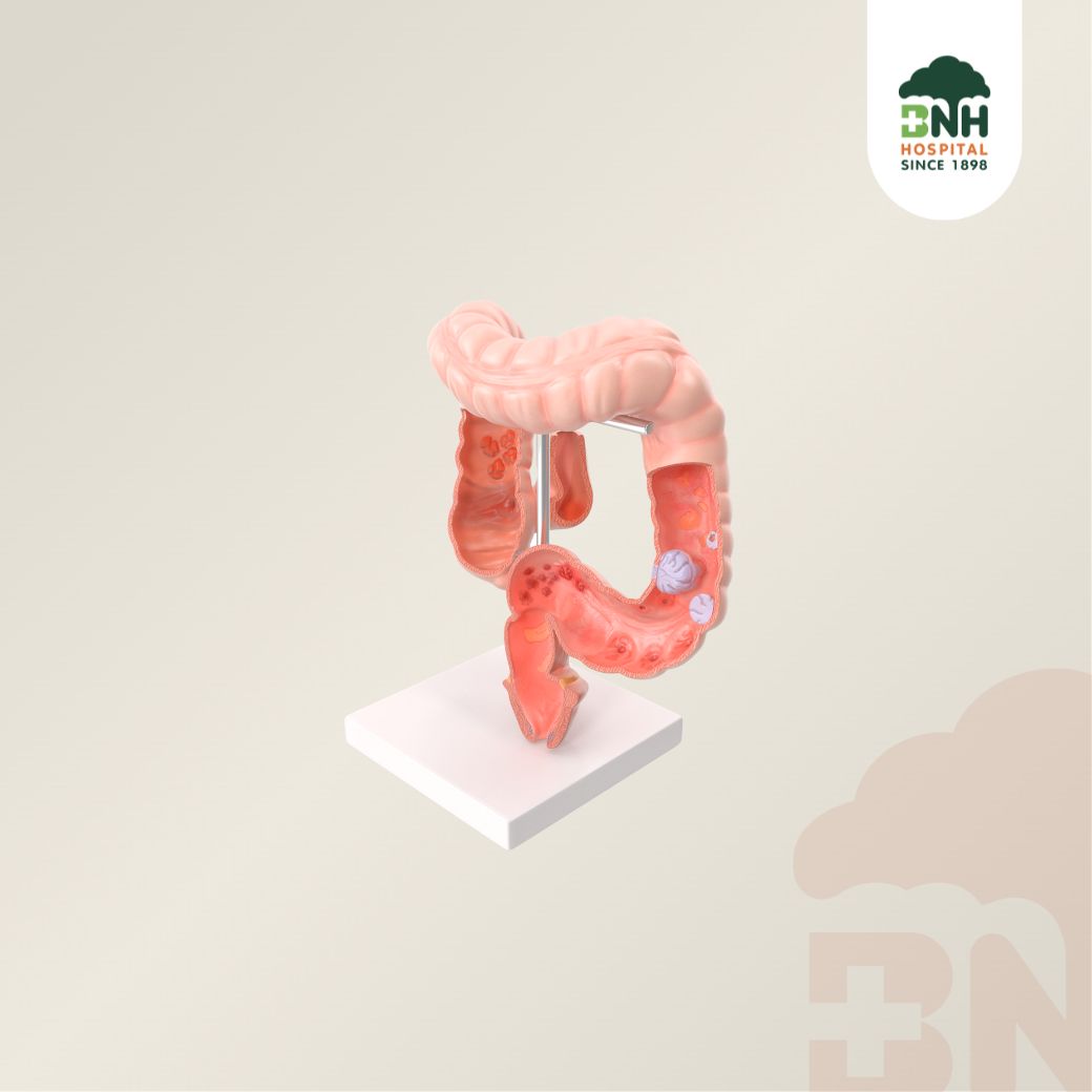 What are the methods for colon cancer screening without colonoscopy ...