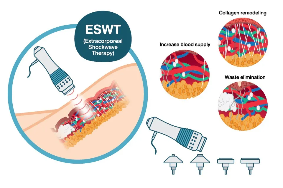 มารู้จักการรักษาโดยคลื่นกระแทกกัน - BNH HOSPITAL